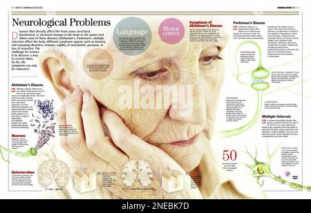 Senile plaque in cerebral cortex, light micrograph Stock Photo - Alamy
