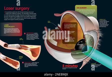Infographic of an angioplasty and ocular surgery (or eye surgery) by ...