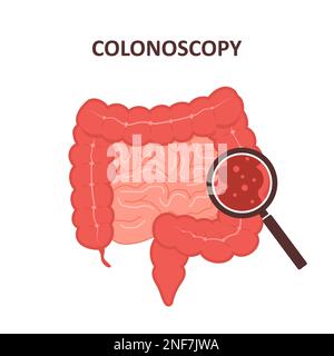 Colonoscopy procedure. Intestine exam and treatment. Colon polypectomy ...
