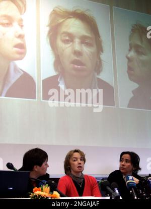 Isabelle Dinoire, left, the woman who received the world's first ...