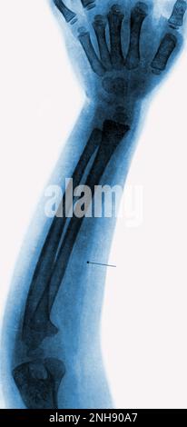 X-ray of the left arm of a 4-year-old child with polio, showing ...