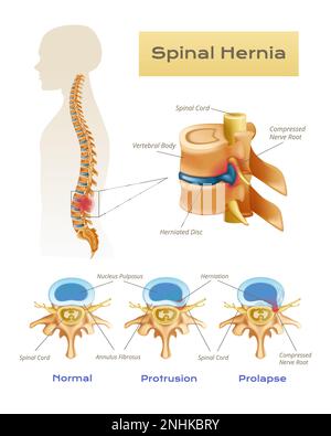 Vertebrae spinal cord anatomy infographics with body silhouette with ...