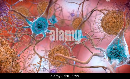 Alzheimer's disease. Illustration of amyloid plaques amongst neurons and neurofibrillary tangles ...