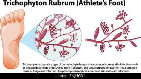 Trichophyton Rubrum fungal infection illustration Stock Vector Image ...