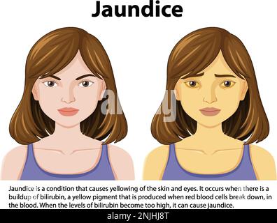 Jaundice disease vector concept illustration Stock Vector Image & Art ...