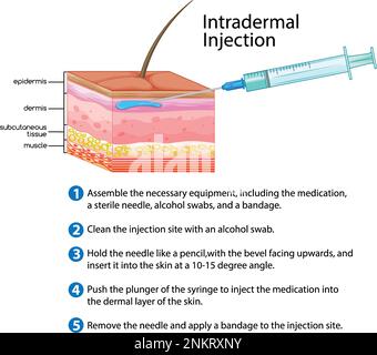 Intradermal Injection with explanation illustration Stock Vector Image ...