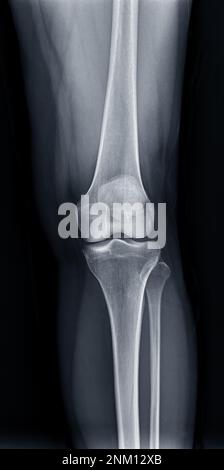 Film x-ray of Left knee joint Lateral view for diagnosis knee pain from ...