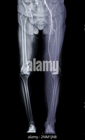 X-ray image of leg Fusion with CTA Femoral run off Stock Photo - Alamy