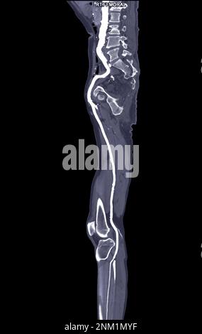 CTA femoral artery run off showing femoral artery for diagnostic Acute ...