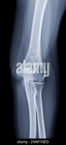 film x-ray elbow AP/Lateral : normal human's elbow Stock Photo - Alamy
