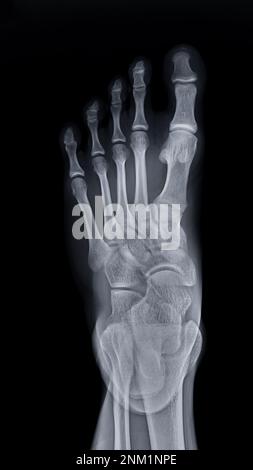 Foot and ankle pain on x-ray, isolated on black background, heel pain ...