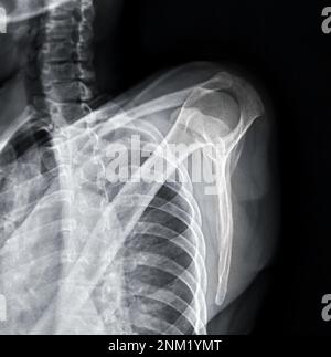 X-ray Shoulder joint shoulder transcapular view for diagnosis fracture ...