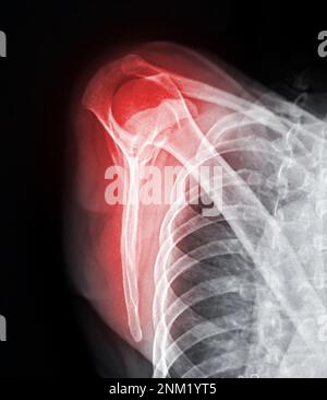 X-ray Shoulder joint shoulder transcapular view for diagnosis fracture ...