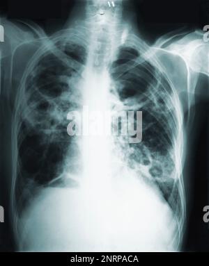 X-Ray of the chest in a patient with Active pulmonary Tuberculosis (TB ...