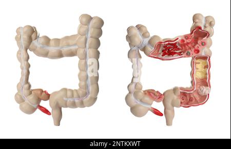 Anatomical model of large intestine isolated on white. Gastroenterology ...