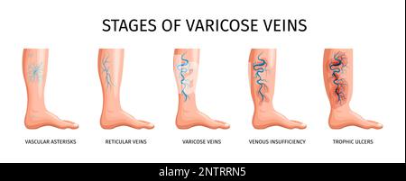 Varicose veins realistic infographics vector illustration with stages ...