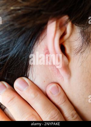 Irritation on the skin behind the ear. Man with flaky skin. Allergy or ...