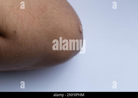 Teenage Boy with Wart on Arm: Causes, Treatment, and Prevention Stock ...