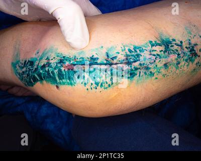 Patient with arthritis after total knee replacement. The doctor checks ...