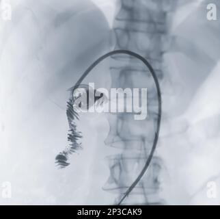 X-ray image of portal vein after Doctor doing ERCP and laparoscopic ...