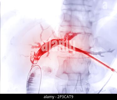 X-ray image of endoscopic after Doctor doing ERCP and laparoscopic ...