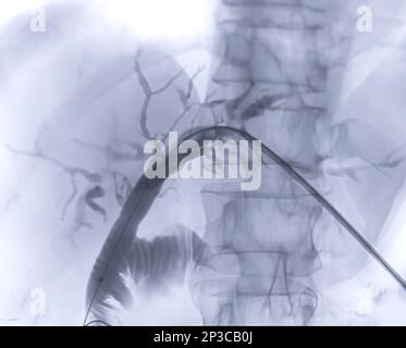 X-ray image of endoscopic after Doctor doing ERCP and laparoscopic ...