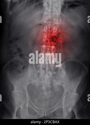 x-ray showing degenerative disc disease at lumbar vertebrae L5-6 ...