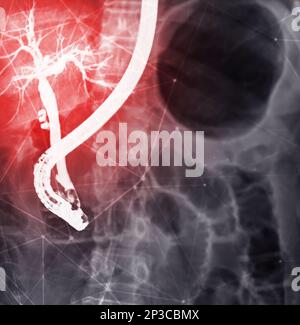 X-ray image of endoscopic after Doctor doing ERCP and laparoscopic ...