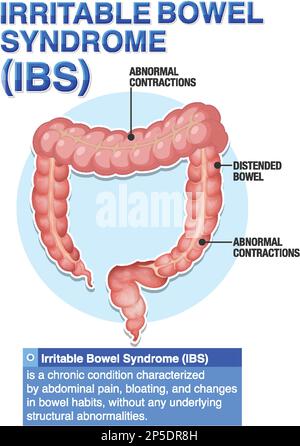Irritable Bowel Syndrome (IBS) Infographic illustration Stock Vector ...