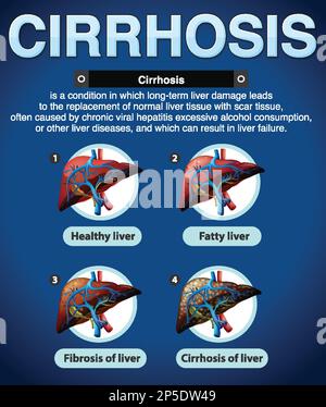Stages of Liver Damage Infographic illustration Stock Vector Image ...