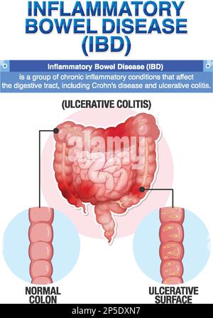 Inflammatory Bowel Disease (IBD) Infographic illustration Stock Vector ...