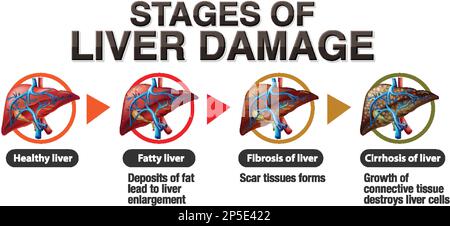 Stages of Liver Damage Infographic illustration Stock Vector Image ...