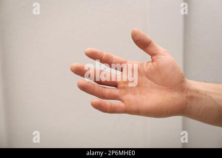 Man suffering from calluses on hand indoors, closeup Stock Photo - Alamy