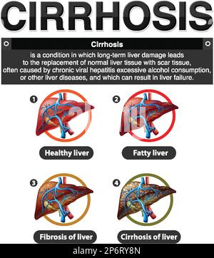 Stages of Liver Damage Infographic illustration Stock Vector Image ...