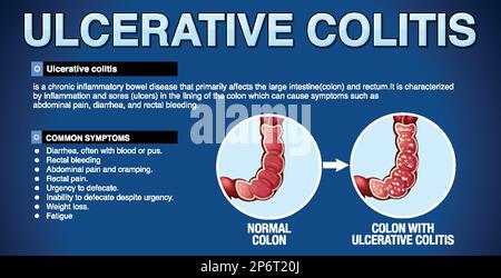 Ulcerative Colitis Symptoms Infographic illustration Stock Vector Image ...