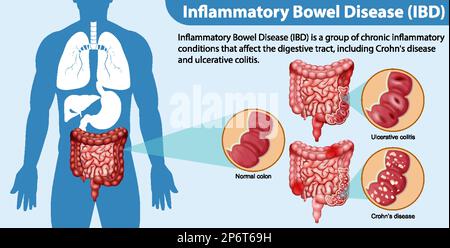 Inflammatory Bowel Disease (IBD) Infographic illustration Stock Vector ...