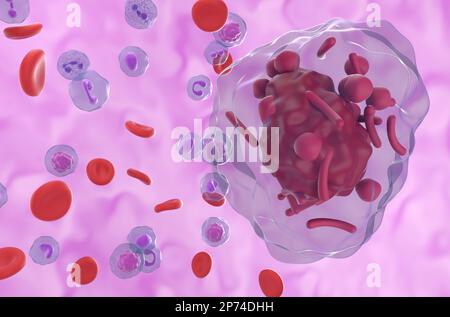 Auer rods (or Auer bodies) in acute Hypergranular Promyelocytic ...