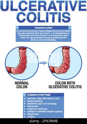 Ulcerative Colitis Symptoms Infographic illustration Stock Vector Image ...