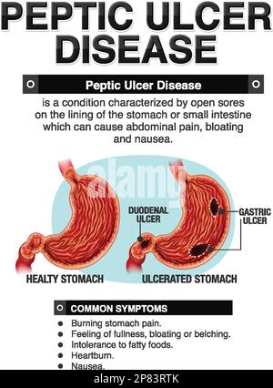 Peptic Ulcer Disease Infographic illustration Stock Vector Image & Art ...