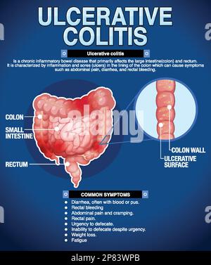 Ulcerative Colitis Symptoms Infographic illustration Stock Vector Image ...