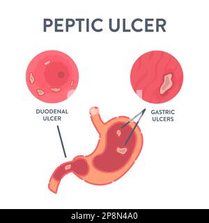 Peptic ulcer disease (PUD), stomach ulcer or gastric ulcer. Human ...