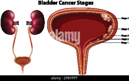 Bladder Cancer Stages Vector illustration Stock Vector Image & Art - Alamy