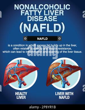 Nonalcoholic Fatty Liver Disease (NAFLD) illustration Stock Vector ...
