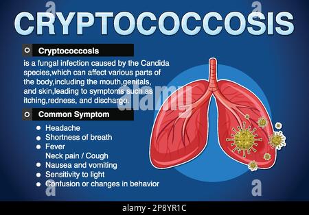 Informative poster of Cryptococcosis illustration Stock Vector Image ...