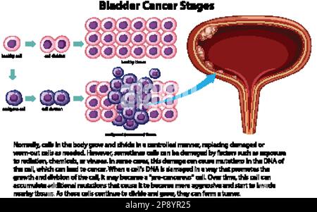 Bladder Cancer Stages Vector illustration Stock Vector Image & Art - Alamy