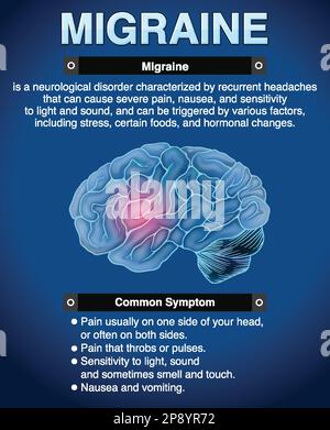 Informative poster of Migraine illustration Stock Vector Image & Art ...