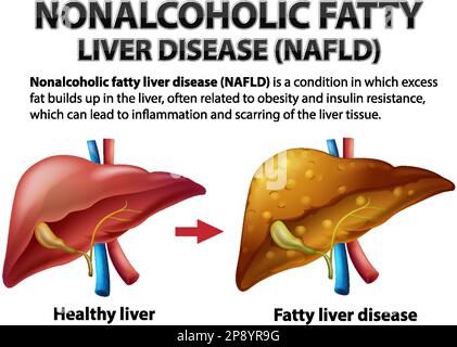 Nonalcoholic Fatty Liver Disease (NAFLD) illustration Stock Vector ...