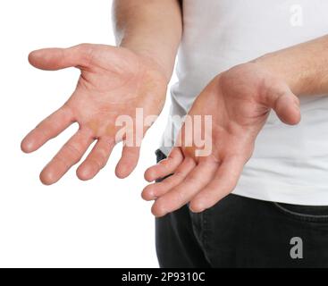 Man suffering from calluses on hand against white background, closeup ...
