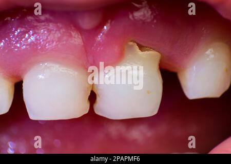 close-up picture of an incisor tooth that is about to erupt in a 7-year ...