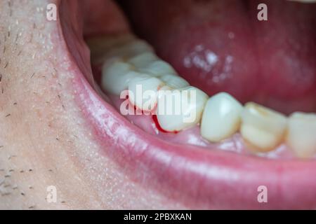 Dental abscess. Close-up of the mouth of a patient with severe tooth ...